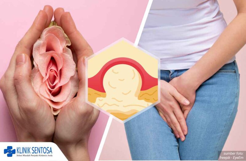 Bartholinitis Dan Kista Bartholin Kenali Perbedaannya Disini Klinik