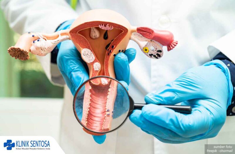 Iritasi pada Miss V, Apa Penyebabnya? Cek Disini Yuk! – Klinik Utama Apollo