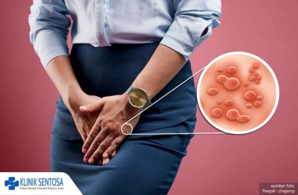 Selangkangan Lecet dan Perih? Begini Cara Mengatasinya! – Klinik Utama ...