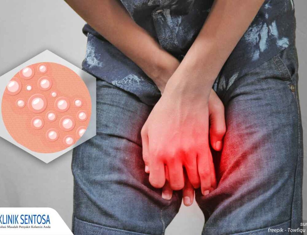 Mengidentifikasi Ciri-ciri Balanitis yang Akan Sembuh