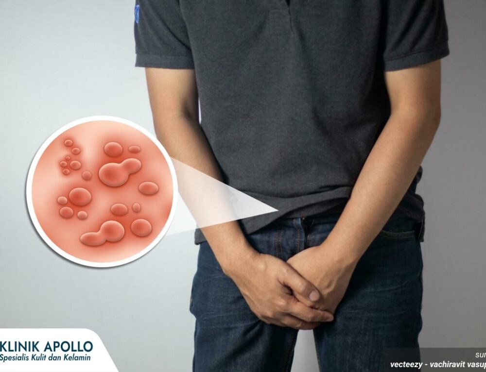 Ereksi Keras dan Tahan Lama, Begini Solusinya! – Klinik Utama Apollo